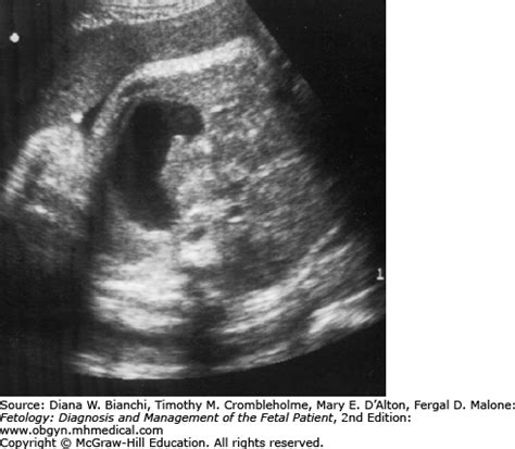 Pyloric Atresia And Stenosis Obgyn Key