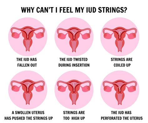 Premium Vector Causes Not Feel Iud Strings Intrauterine Device In Vector