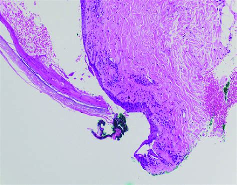 Low Power Magnification Demonstrating Focal Interface Dermatitis With