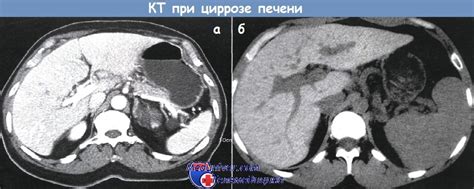 Цирроз печени диагностика