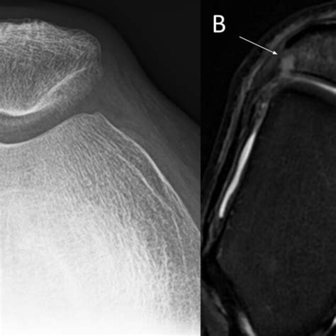 Metabolic Disease Calcium Pyrophosphate Deposition Disease 69 Year Old