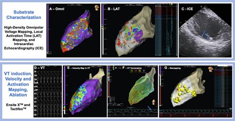 First In Human Endocardial Catheter Ablation Of Vt Using A Novel