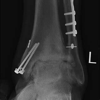 Anteroposterior Radiograph Of The Ankle Showing Advanced Osteoarthritis Download Scientific