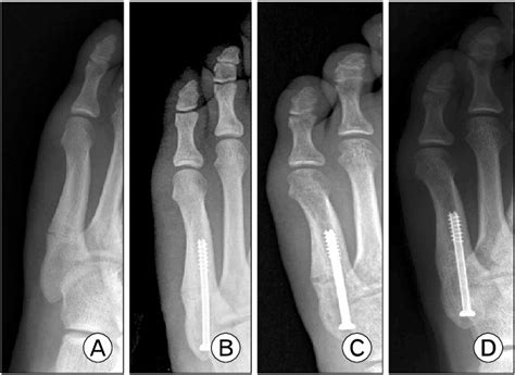 Nineteen Year Old Male Soccer Player X Ray Reveals Torg Classification