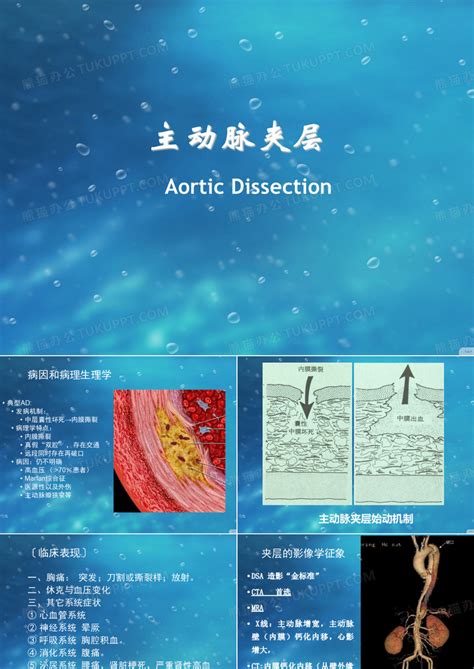 主动脉夹层PPT模板下载 编号lgmryzma 熊猫办公