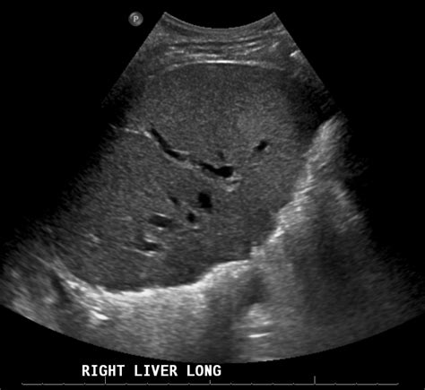 Normal Liver Ultrasound Two Dimensional Ultrasound Can It Replace