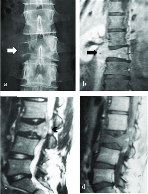 Ewing Sarcoma Of L3 A Plain Radiograph Of Lumbar Spine Reveals Lytic