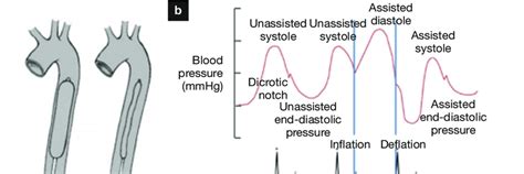 Intra Aortic Balloon Pump Waveform