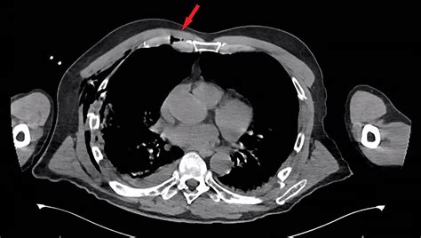 Costochondral Junction