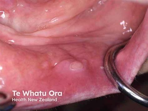 Mouth Ulcer Image