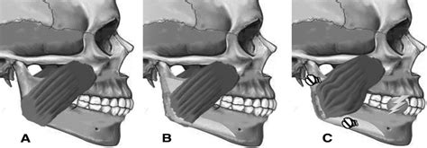 The Treachery Of Mandibular Angle Augmentation Annals Of Plastic Surgery