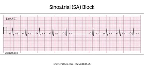 Sinoatrial Sa Block Ecg 8 Second Stock Vector Royalty Free 2258363565 Shutterstock