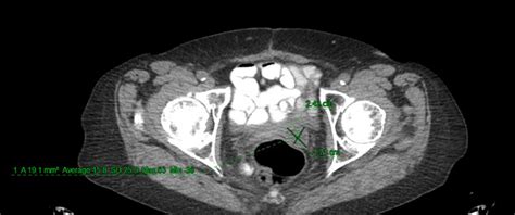 PET CT Scan Showing New Local Recurrence At The Lest Aspect At The Download Scientific Diagram