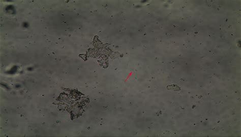 A Hyperpigmented Intermammary Patch The Bmj