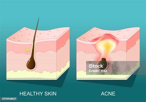 Ilustración De Acné Sección Transversal De Una Piel Humana Con Grano Y