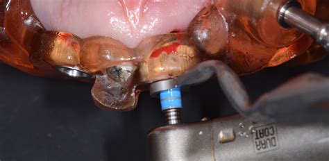 Esthetics And Immediate Loading Protocols Iti Blog