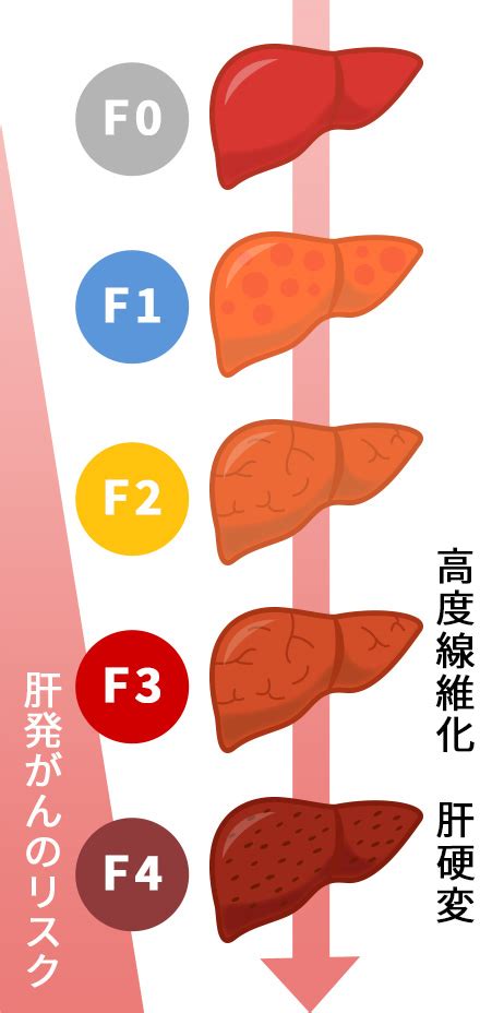 Fib 4 Index｜順天堂大学医学部附属静岡病院 肝疾患相談支援センター