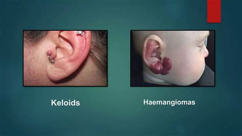 TUMORS OF EAR PPTX