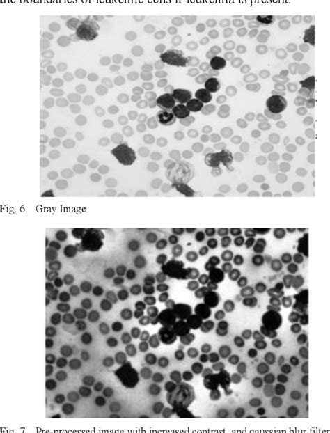 Figure 6 From Detection And Classification Of Various Types Of Leukemia Using Image Processing
