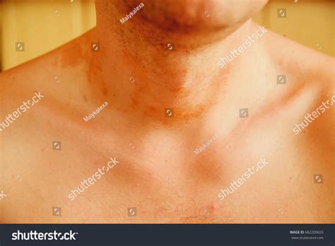 Allergic Skin Rash Spots On Neck库存照片682209655 Shutterstock