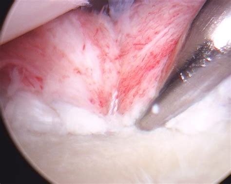 Treating Shoulder Dislocation Uw Orthopaedic Surgery And Sports Medicine