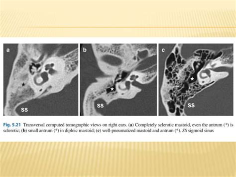 Temporal Bone Mastoid Anatomy Arjun Antony Graison PPTX
