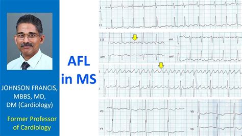 Atrial Flutter In Mitral Stenosis Youtube