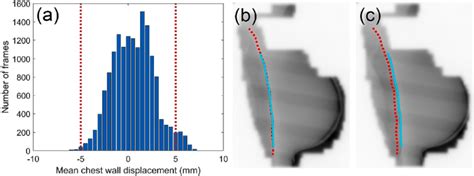 A Distribution Of Measured Mean Cw Displacements For All Patients A