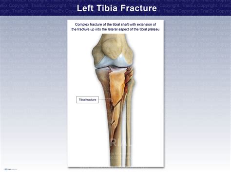 Left Tibia Fracture Trialquest Inc