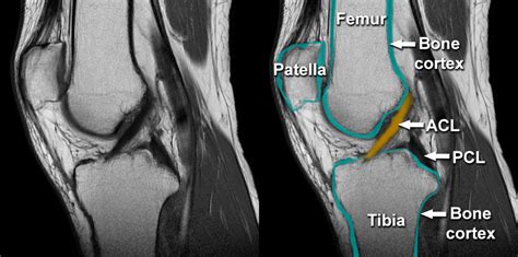 Mri Gallery Mri Knee Acl Tear