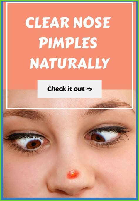 Pimples In Your Nose How To Get Rid Of Them Common Causes Artofit