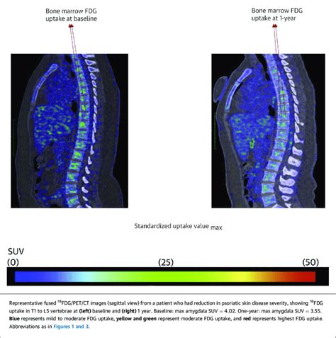Bone Marrow 18 Fdg Uptake At Baseline And 1 Year Download Scientific Diagram