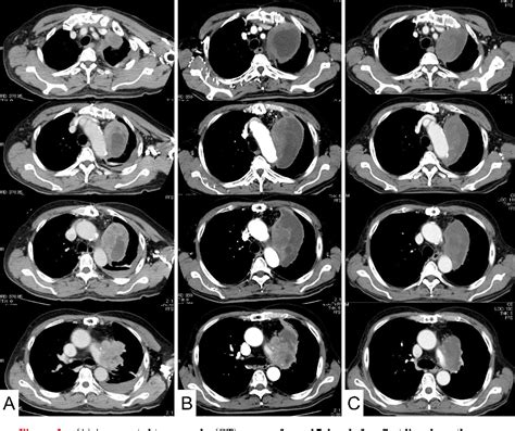 Figure 1 From Intimal Sarcoma Of The Pulmonary Artery Treated With Pazopanib Semantic Scholar