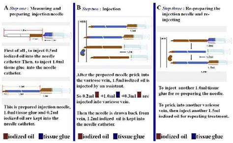 Sa1612 A Modified Approach Of Endoscopic Tissue Glue Injection For The
