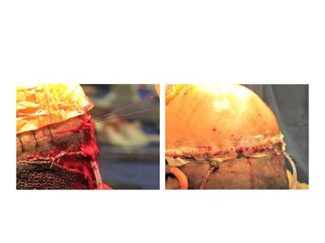 Decompressive Craniectomy Dr Shameej Ppt