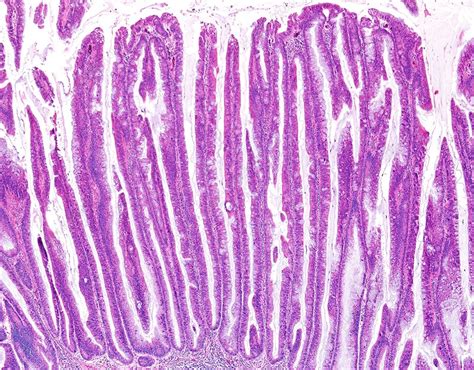 Villous Colon Polyp Light Micrograph Stock Image C038 9571 Science Photo Library