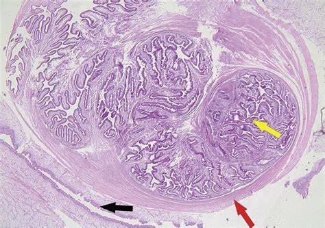 Teaching Neuroimages Spinal Intramedullary Cysticercosis Neurology