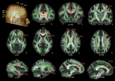 Men With Autism Have Unusual Frontal Lobe Connections In The Brain Diffusion Tensor Imaging Reveals