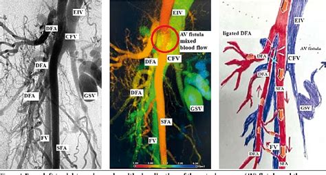 Figure 1 From Endovascular Treatment Of Post Thrombotic Syndrome Of The