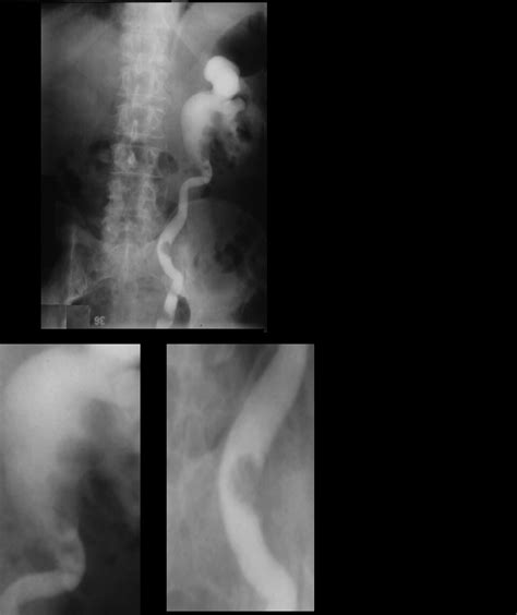 Filling Defect Ureter Us The Common Vein