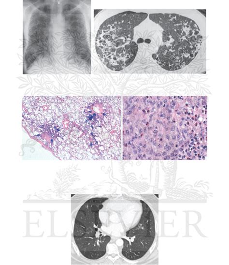Diffuse Cystic Lung Diseases Continued