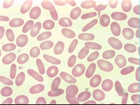 Ovalocytes