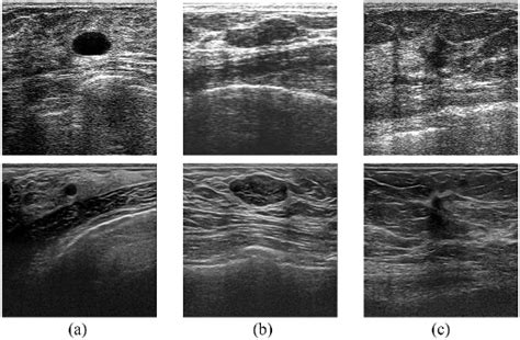 Pdf Automated Breast Ultrasound Lesions Detection Using Convolutional Neural Networks 2018