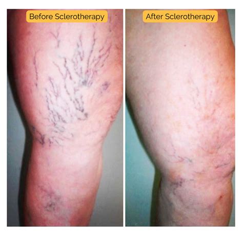 Varicose Veins Edmonton Vein Clinic