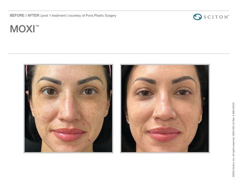 Moxi Laser Treatment Chicago Aesthetic Surgery And Med Spa