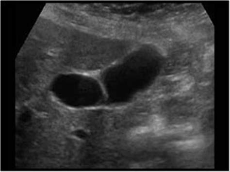 Abnormal Ultrasound Gallbladder