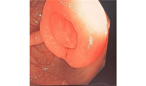Colonoscopy Showing Bowel Intussusception Download Scientific Diagram