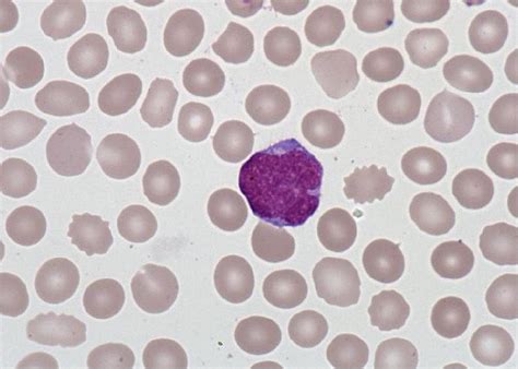 Mantle Lymphoma Lymphocytes Horiba