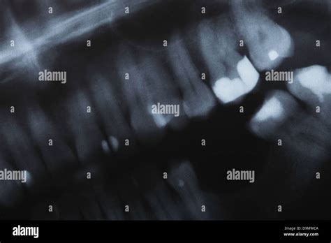 Detail X Ray Image Scan Of Humans Teeth Stock Photo Alamy