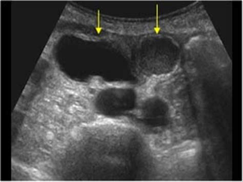 Abdomen And Retroperitoneum 12 Gallbladder And Bile Ducts Case 12